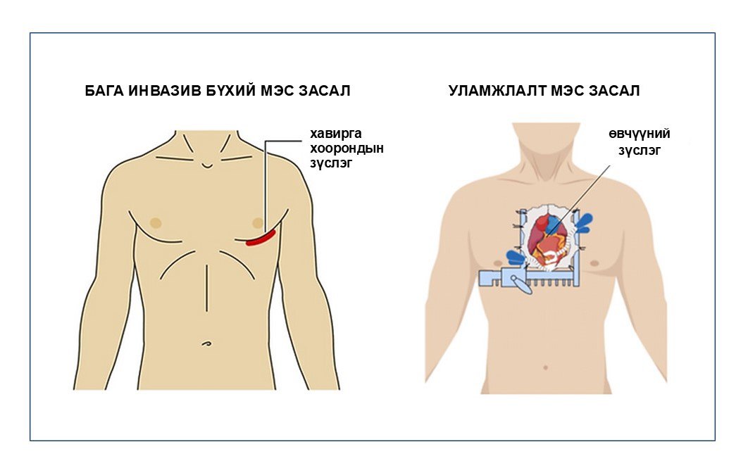 Монгол улсад анх удаа агшиж буй зүрхэнд титэм судас нөхөн сэргээх мэс заслыг амжилттай хийлээ